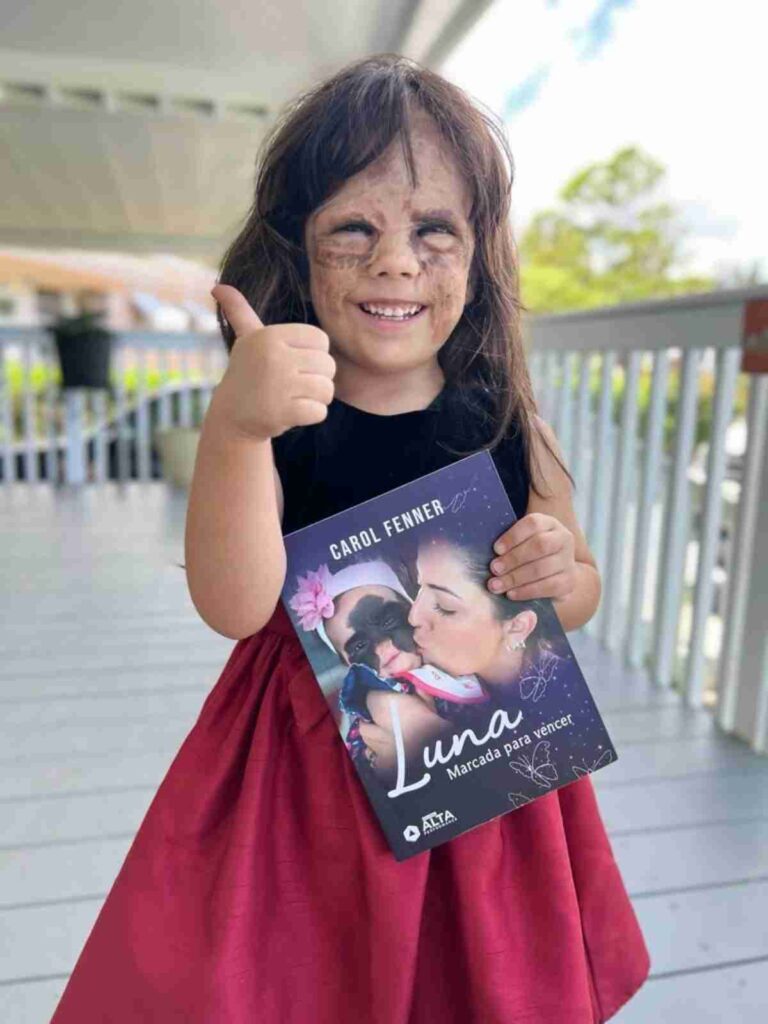 Ela viralizou ao nascer com uma grande marca de nascença; veja como ...